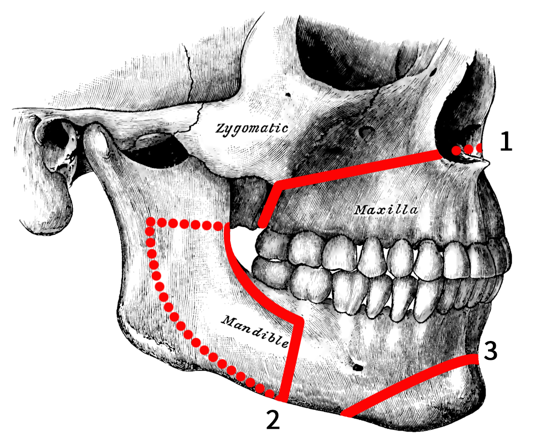 Osteonecrosi della mandibola: 10 cose da sapere | Centro Medico Vesalio