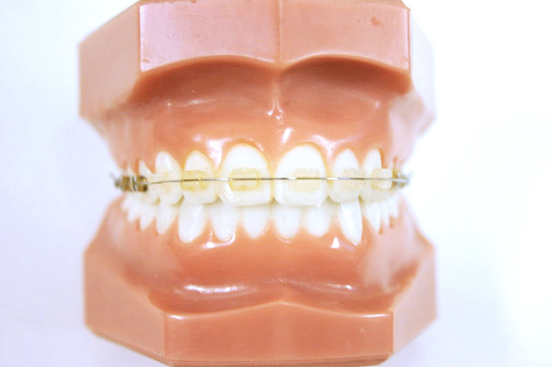 A cosa serve lo splintaggio ai denti | Centro Medico Vesalio